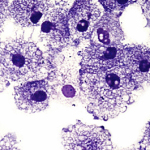 LDH alto, di cosa si tratta | Ability Channel