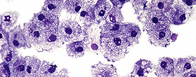 LDH alto: cos'è, di cosa si tratta e quali sono le cause