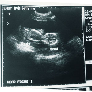 Focomelia cause e manifestazioni - Ability Channel