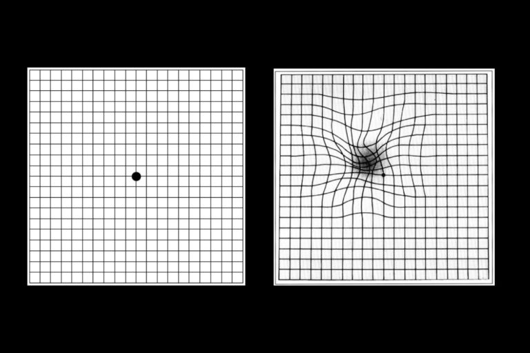 Test di Amsler: a cosa serve la griglia per la degenerazione maculare