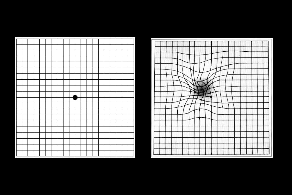 Test di Amsler: a cosa serve la griglia per la degenerazione maculare
