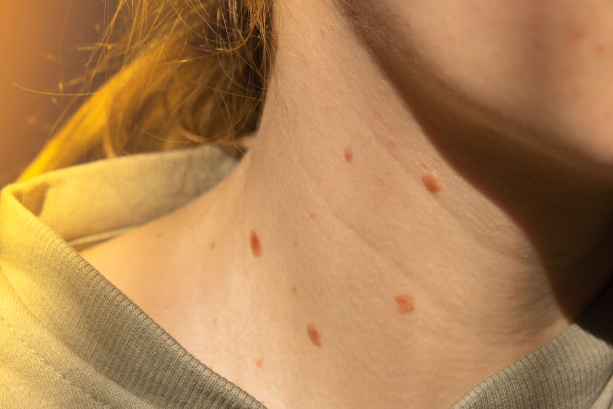 Tumori della pelle: quanti sono, sintomi, cause, prevenzione e cure