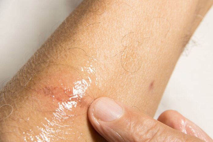 Dermatite da sudore: cos'è, sintomi, cause e come si cura